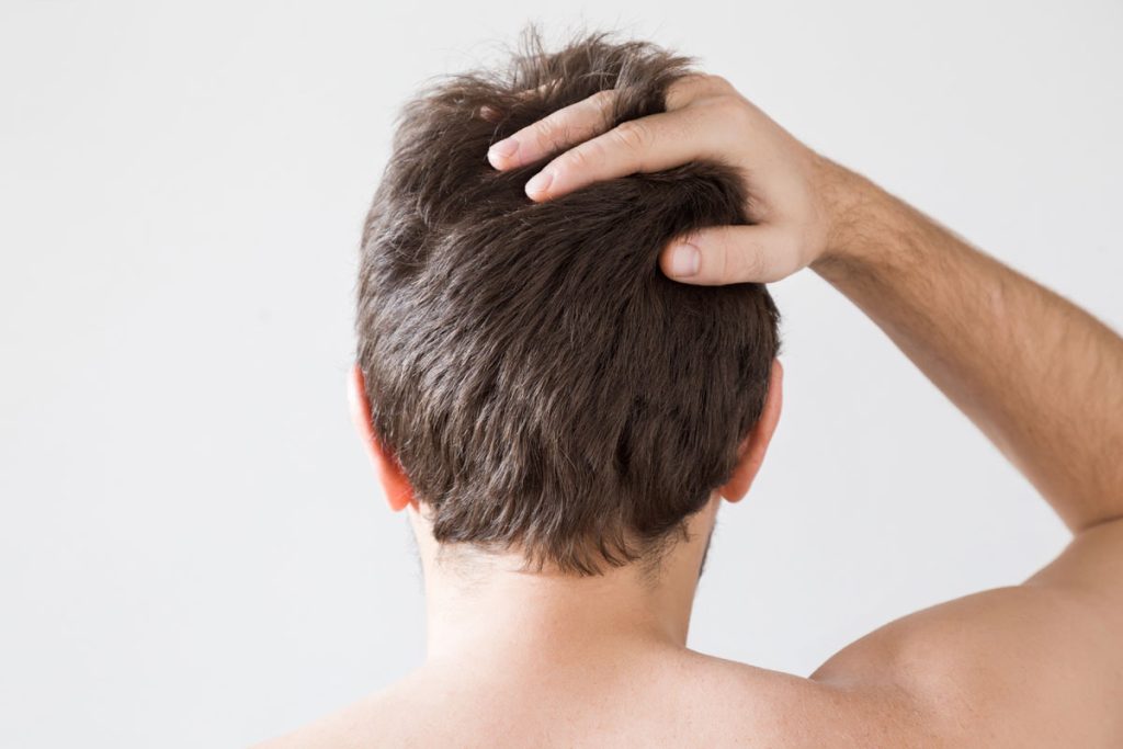 I capelli danneggiati possono portare alla calvizie?