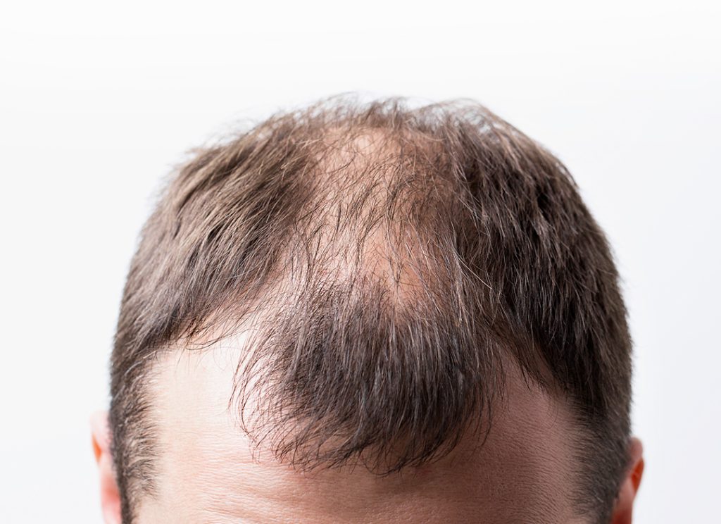 La Caduta Capelli nell'Uomo: Cause e Soluzioni