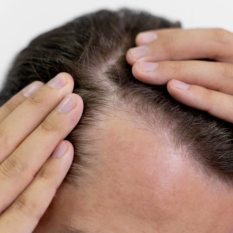 Le cause della Caduta dei Capelli nell'uomo - Sanders