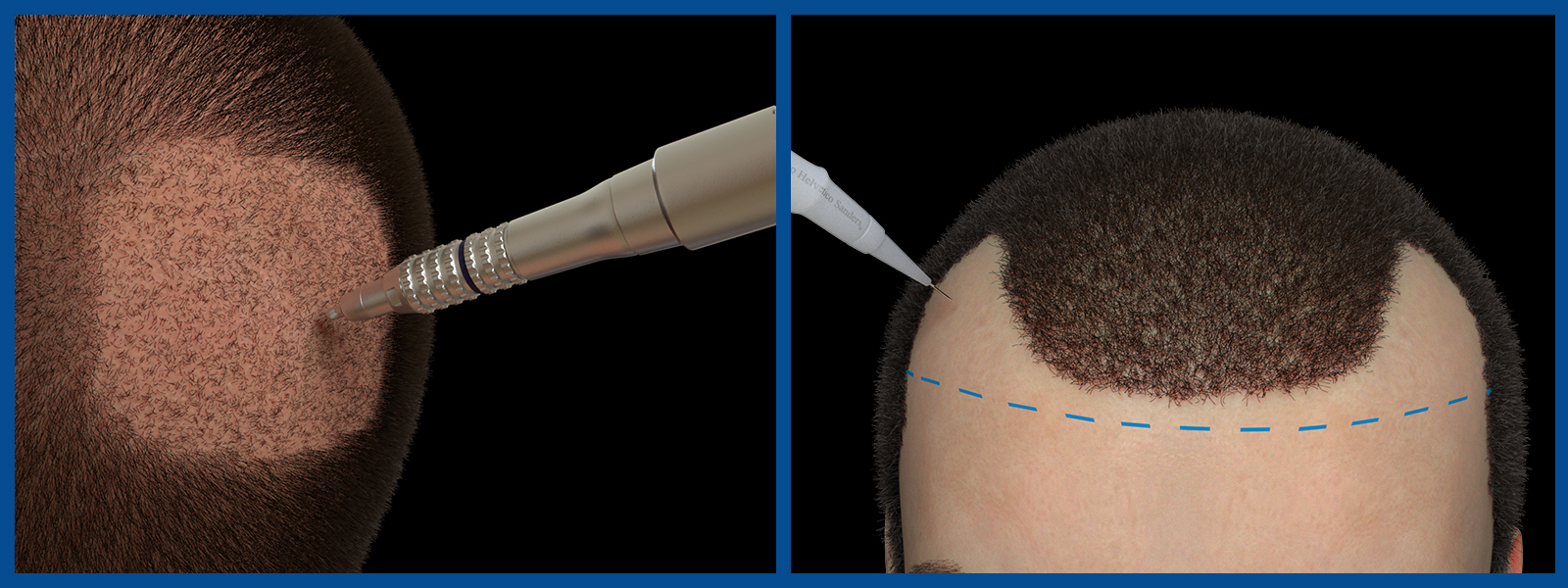 Il falso mito della striscia di cute nel trapianto capelli | Sanders