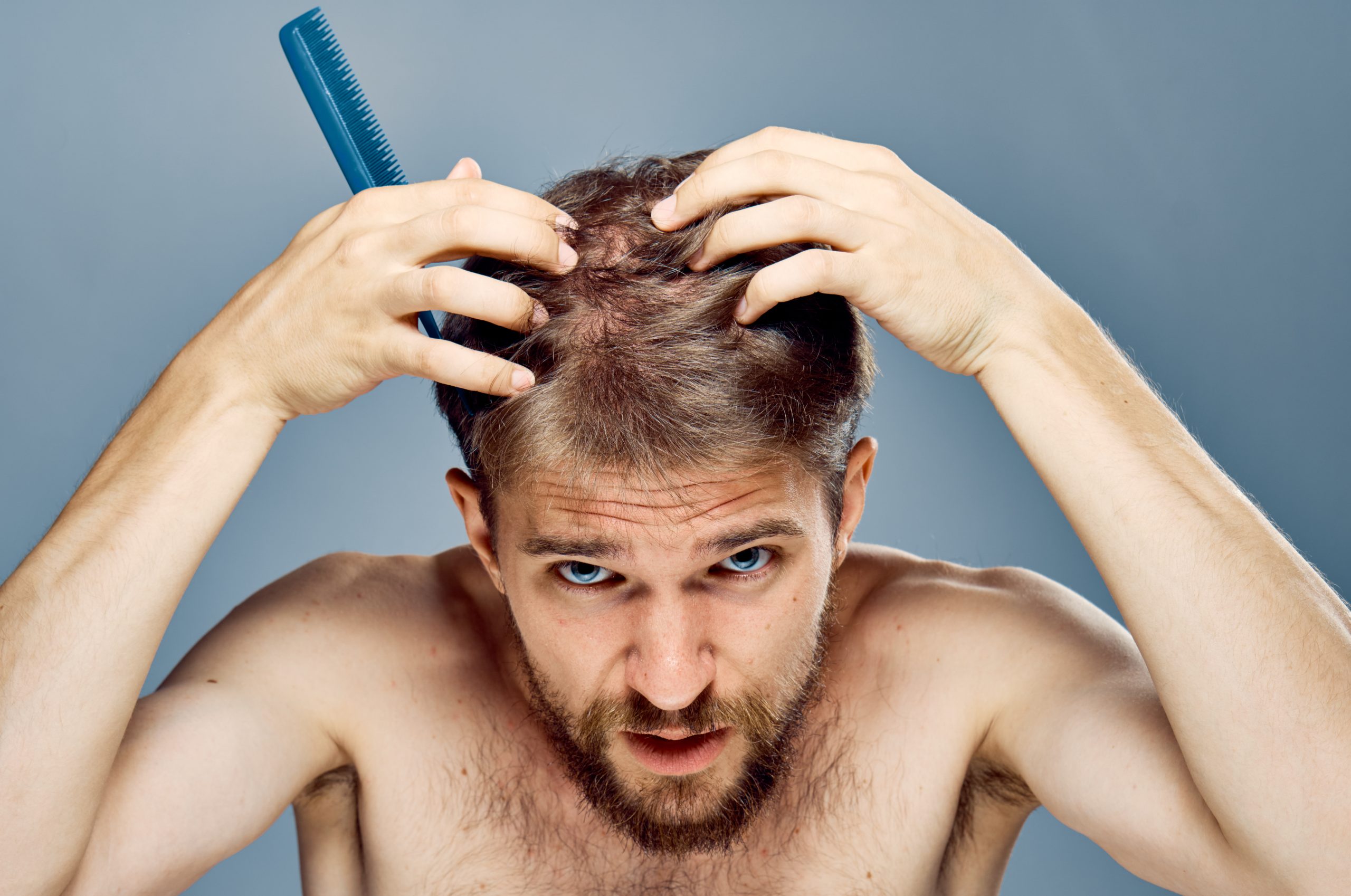 La progressione calvizie: i segnali