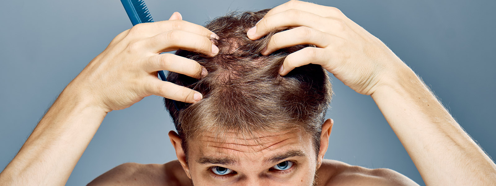 Calvizie Precoce: Cause e Possibili Rimedi - Istituto Helvetico Sanders