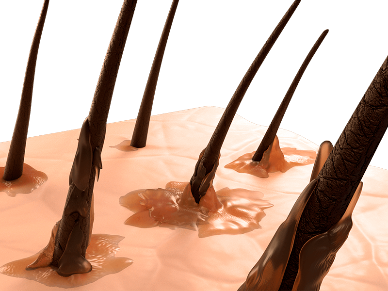 Seborrea e dermatite seborroica - Istituto Helvetico Sanders