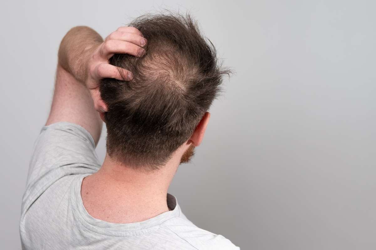 Cosa fare per i capelli grassi? Possono favorire la calvizie?