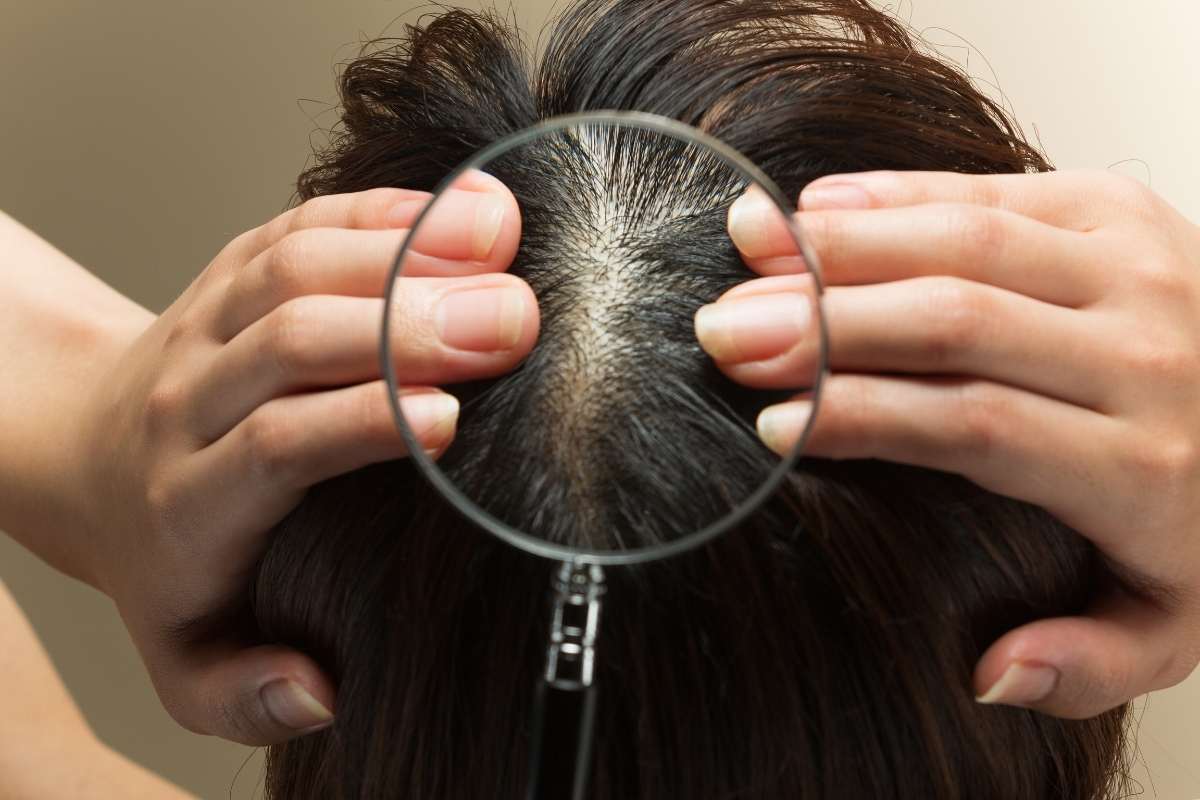 Cosa fare per i capelli grassi? Possono favorire la calvizie?