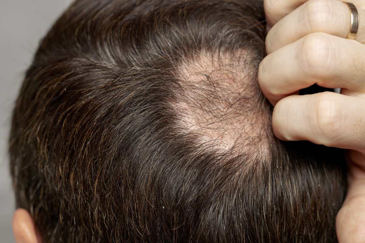 Depressione e perdita di capelli, cosa c'è da sapere